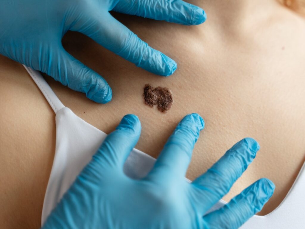 Why Do Warts Keep Coming Back? Causes, Treatment, and Prevention ...